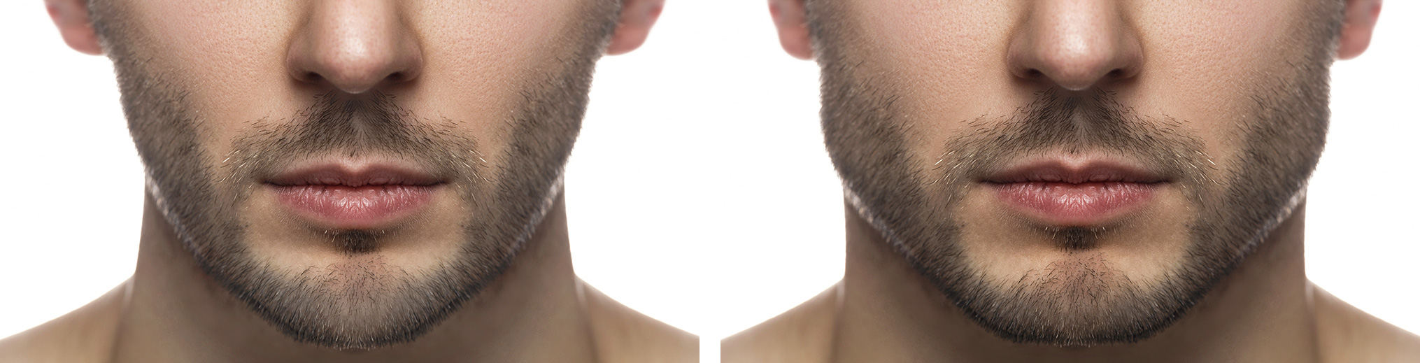 Ángulos mandibulares